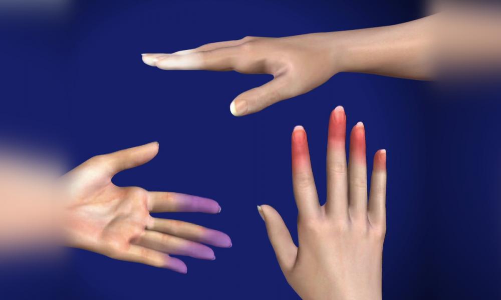 Φαινόμενο Raynaud: Γιατί τα δάχτυλά σου γίνονται μπλε; | Pentapostagma